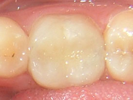 Fusión Oral Consultorio y Laboratorio Dental: Incrustaciones Estéticas ...